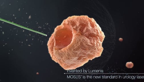 » Moses Holmium laser Technology